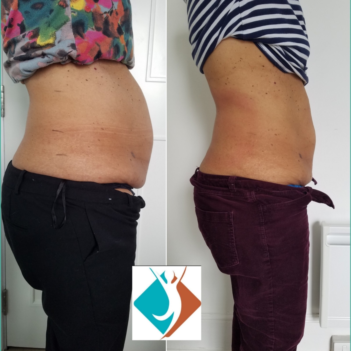 Non Surgical fat reduction. Body contouring treatments in Croydon