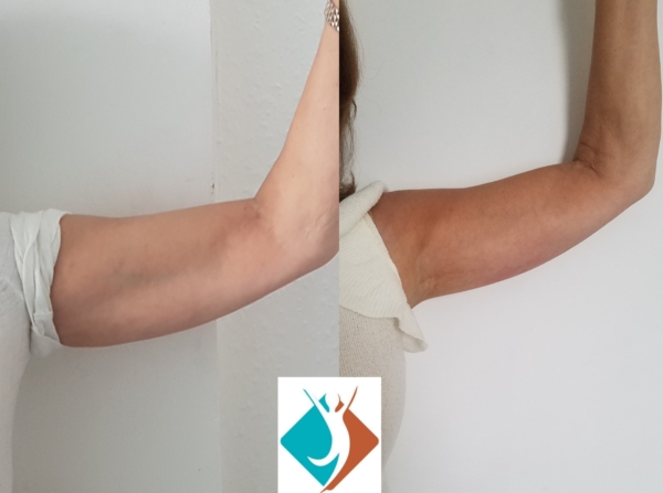 Non-Surgical Arm Fat Reduction in Croydon, South London