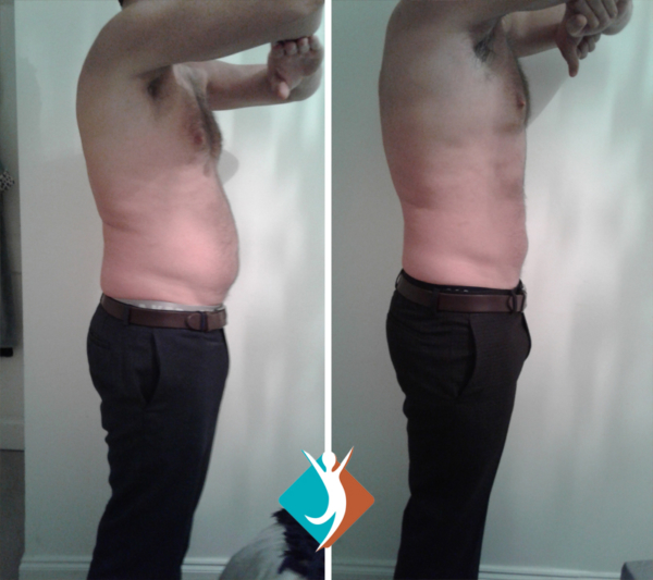 Non-Surgical Abdomen and Flank Fat Reduction